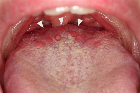 Pathology Outlines Lingual Tonsil
