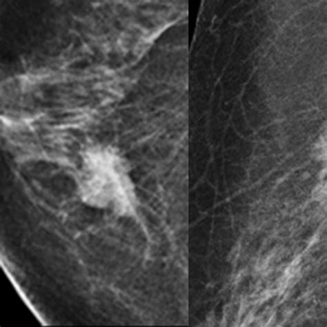 Clustered Coarse Heterogeneous Microcalcifications Associated With A