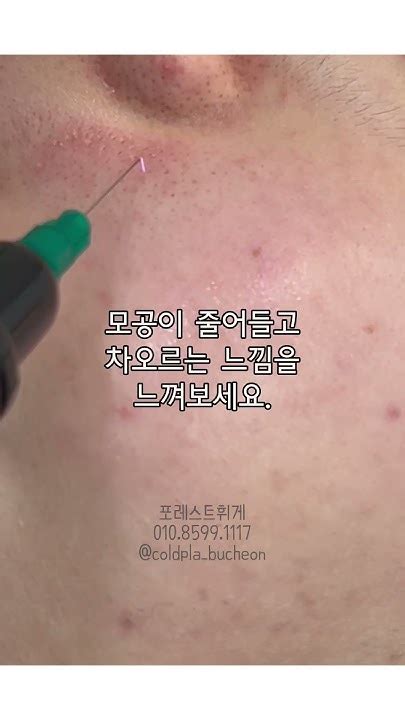 콜드플라 콜드플라즈마 부천피부관리 피부관리 모공개선 모공관리 모공수축 모공케어 모공축소 모공줄이는법 모공