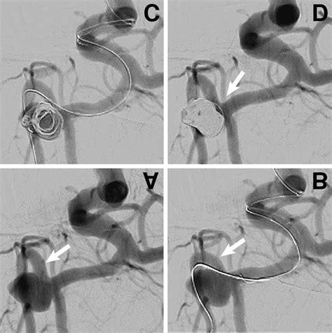 Interventional Procedures A Left Internal Carotid Angiogram Showing