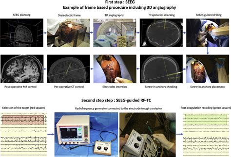 Surgical Techniques Stereoelectroencephalography Guided Radiofrequency