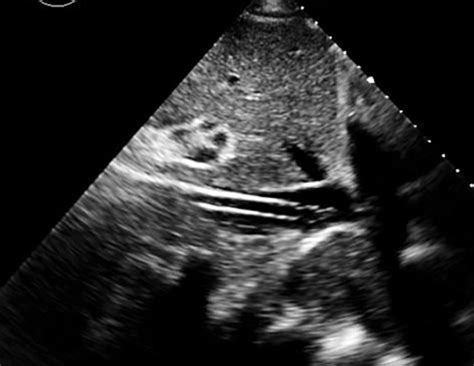 Ultrasound Guided Positioning Of The Return Cannula In The Ivc Ivc