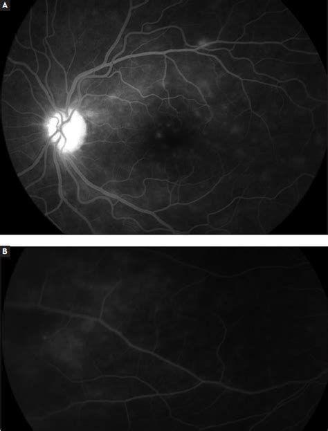 Lab Testing In Posterior Noninfectious Uveitis What When And Why