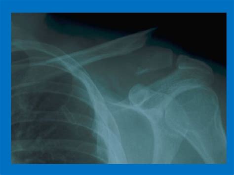 Upper Extremity Fractures And Dislocations Clavicle Fracture Epidemiology