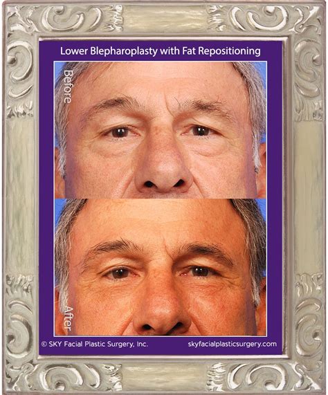 Blepharoplasty Eleven — Sky Facial Plastic Surgery
