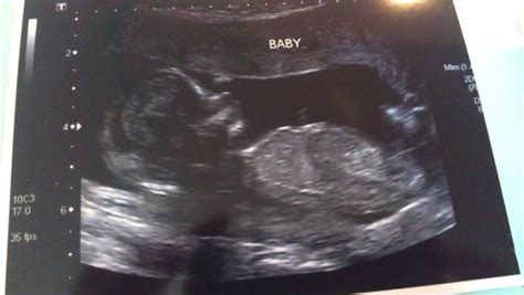 How To Tell Your Baby S Sex At W Scan Nub Theory January BabyCenter Canada