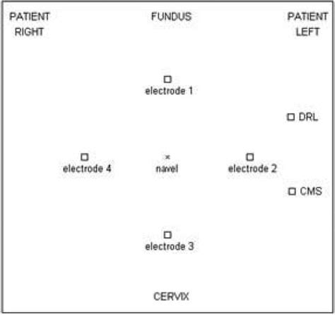 Monitoring Uterine Activity During Labor A Comparison Of Three Methods PMC
