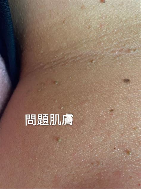 你有問題肌膚的困擾嗎？肉芽？粉刺？痘痘？敏感？脫皮？脫屑？ 晚上來了一位大帥哥，脖子、全臉長了滿臉的肉芽，為了此問題，他困擾了很久，不得不來找姐姐我，數量真的有點多，需要數次才能處理好。 肉芽