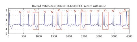 The Ecg Signal With Ventricular Trigeminy Download Scientific Diagram
