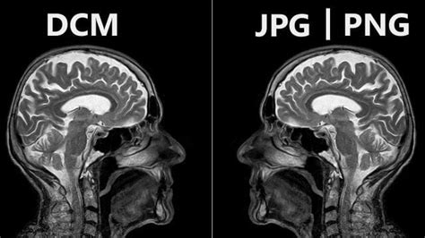 How To Convert Compressed Dicom Images To PNG Journey Bytes