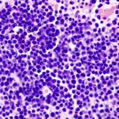 GEP Classifier Predicts Risk In MM MDedge Hematology And Oncology