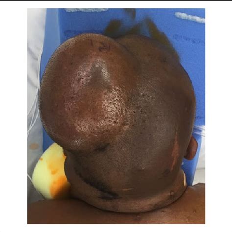 Preoperative Scalp Sarcoma With Expander In Place Download