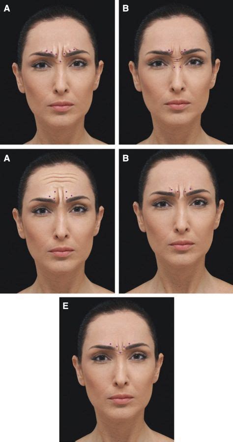 Pin By Euda224 Pinheiro On Estética Avançada ️👩‍⚕️ Botox Facial