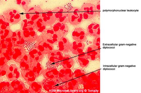 Disease Flashcards Quizlet