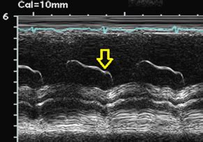 Echo 2 Midterm Flashcards Quizlet