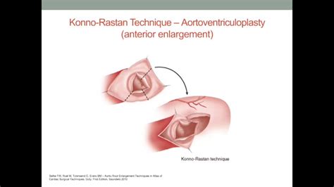 Course 5 Aortic Root Enlargement Procedures And Aortic Valve Leaflet Reconstruction Youtube