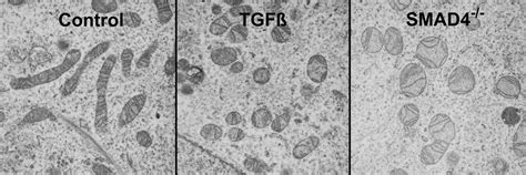 Paradoxical Role Of Smad4 Loss In Pancreatic Cancer Research