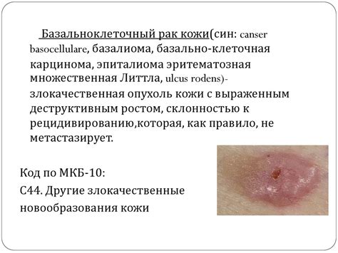 Злокачественные опухоли кожи базальноклеточный и плоскоклеточный рак