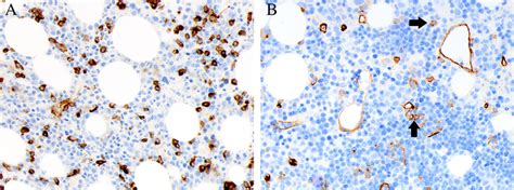 Use Of Cd34 Immunostaining In Mds Cases To Highlight Blasts In Trephine
