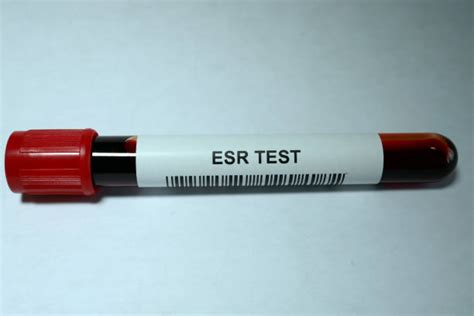 Understanding High Esr Levels Causes Symptoms And Normal Ranges