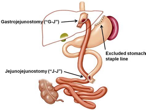 Complications Of Bariatric Surgery Intechopen