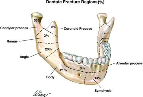 13 Mandibular Fractures Pocket Dentistry
