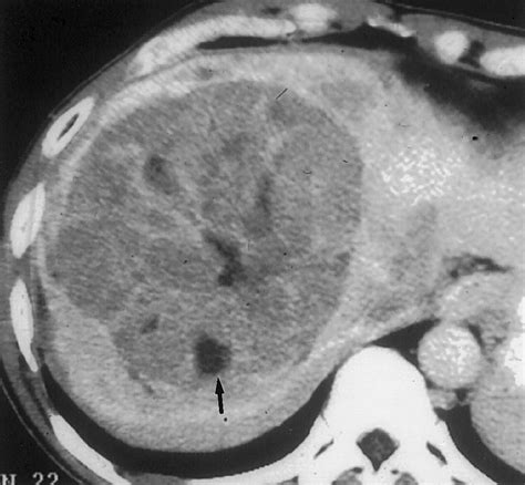 Fat Containing Lesions Of The Liver Radiologic Pathologic Correlation