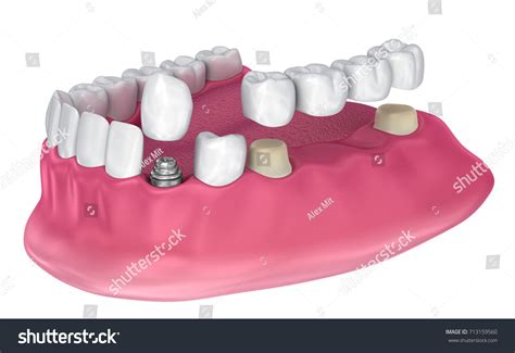 Tooth Supported Fixed Bridge Implant Crown Stock Illustration 713159560