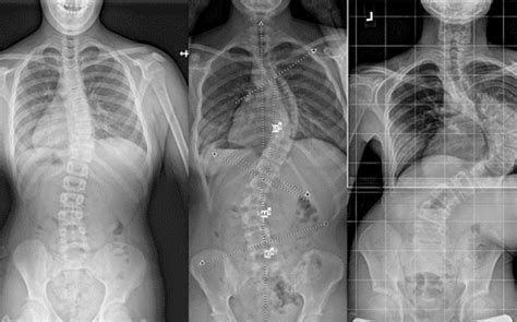Adolescent Idiopathic Scoliosis Anari CHOP OPEN