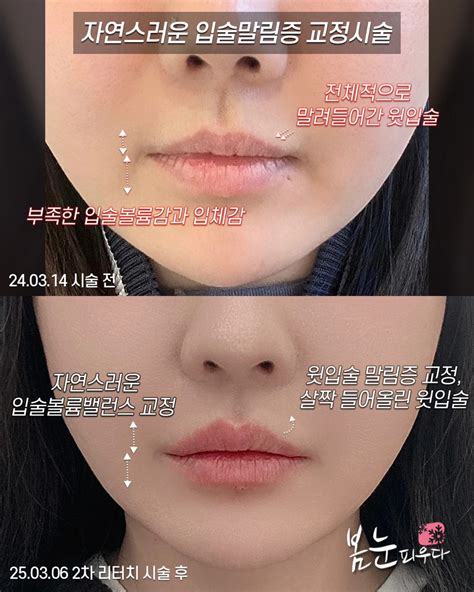 봄눈피우다의원 입술필러를 많이 하면 입술이 처진다🤔 ⠀ 저희 봄눈의 모든 입술시술은 기본 2회로 진행됩니다 그리고 1년