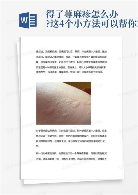 得了荨麻疹怎么办 这4个小方法可以帮你 Word模板下载 编号lwrayvag 熊猫办公