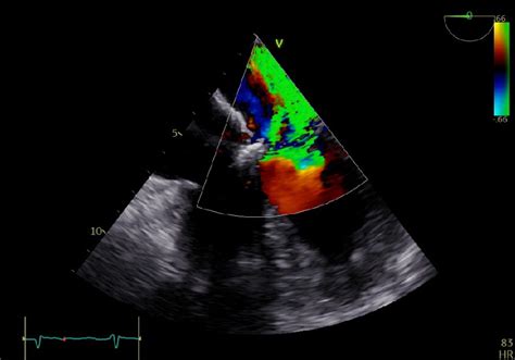 Figure 3 From Surgical Atrial Septal Patch Endocarditis In A Patient