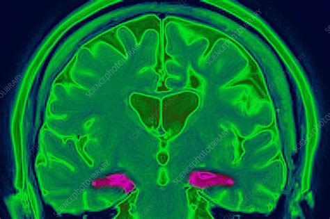 Alzheimers Disease Mri Stock Image C0306773 Science Photo Library