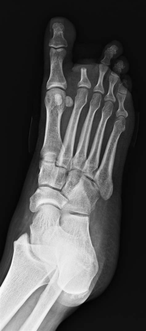 Subtotal Second Toe Amputation Image