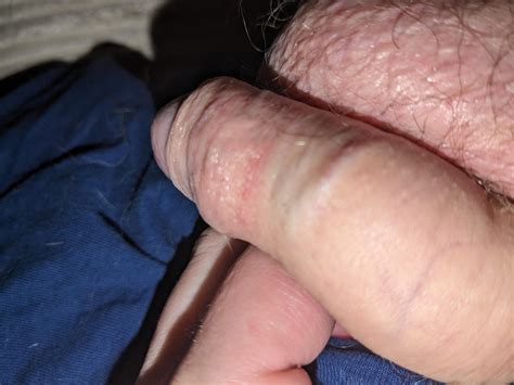 Does This Look Like Balanitis Rbalanitis