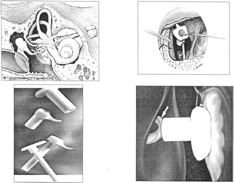 Ossicular Prosthesis Using 4585 Bioglass Download Scientific Diagram
