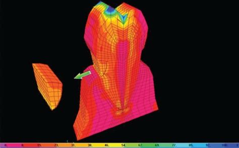 A Wedge Shaped Non Carious Cervical Lesion Restored With A Composite Download Scientific