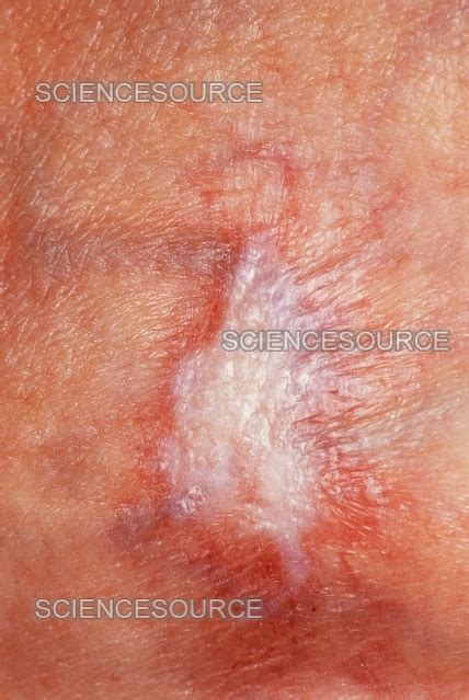 Lichen Sclerosus