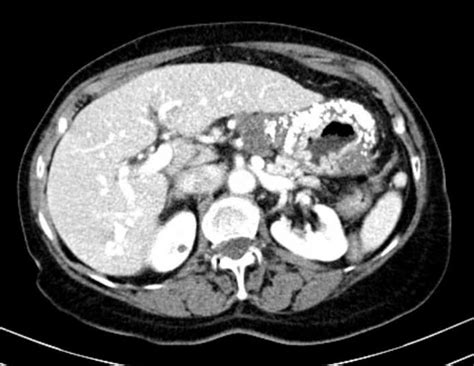 Transversal View Showing The Thickened And Calcified Gastric Wall