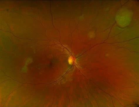 Ophthalmology Dx Spotted Inside The Retina Ophthalmology Advisor
