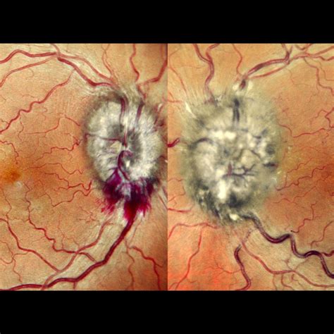 Leukaemic Optic Nerve Infiltration A Pseudopapilledema Presentation Quite Interesting Dr