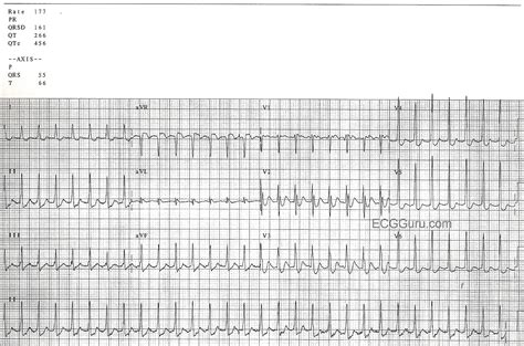 AVNRT ECG Guru Instructor Resources