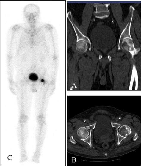 Figure 2 From Unexpected Phosphaturic Mesenchymal Tumor Of The Femoral