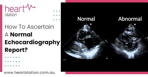 How To Ascertain A Normal Echocardiography Report Heartstation