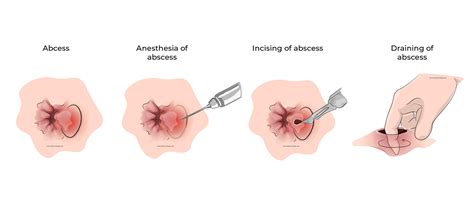 Perianal Abscess Coloproctologie