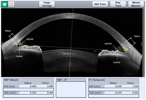 casia2 anterior segment oct display after manual localization of the