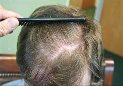 Diffuse Thinning Throughout Top