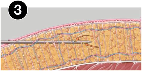 Vaserlipo Ultrasound Assisted Liposuction