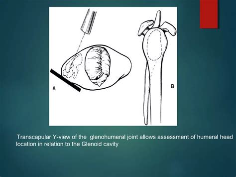 Shoulder Instability Ppt