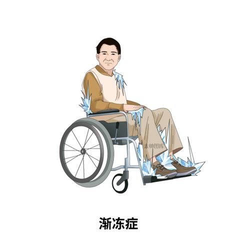 渐冻症 医学插画